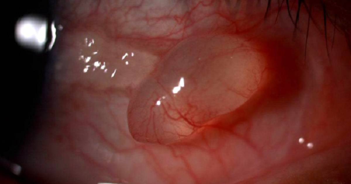 Skin-Crawling Video Shows Man Pops Blister On His Own Eyeball ...