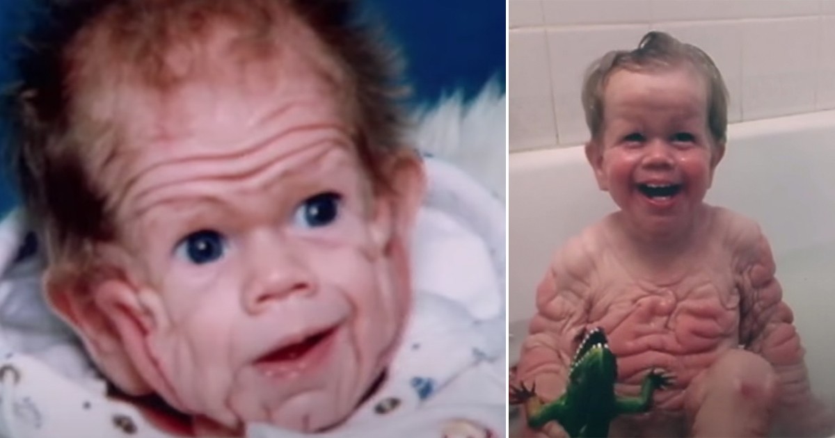 Tomm Tennent: Unique Baby Born With Enough Skin To Cover The Body Of A ...
