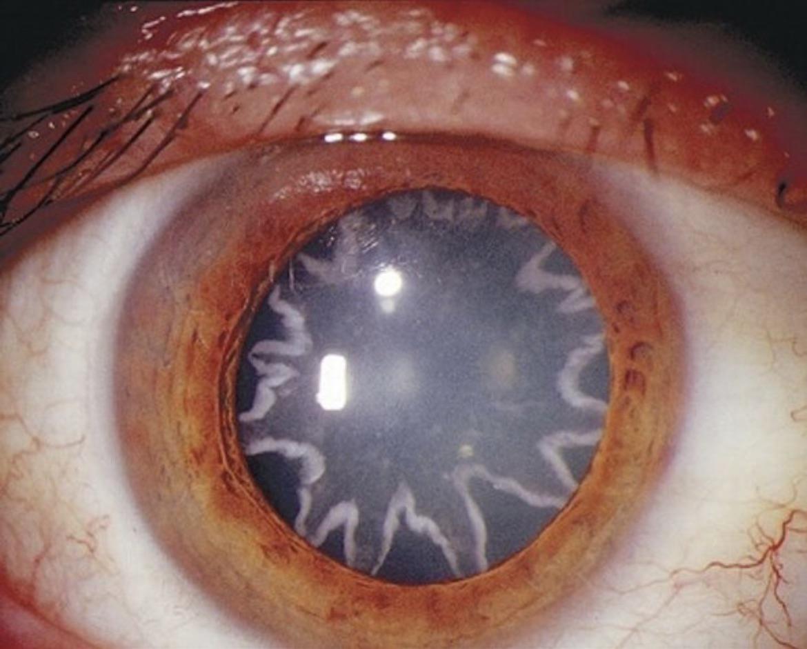 Man Left With Strange Burns In His Eyes After Being Zapped With 14,000 ...